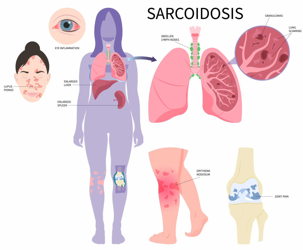 Fall Vaccines — Foundation for Sarcoidosis Research